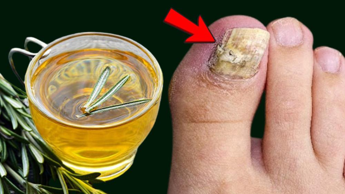 Rosmarin Gegen Nagelpilz